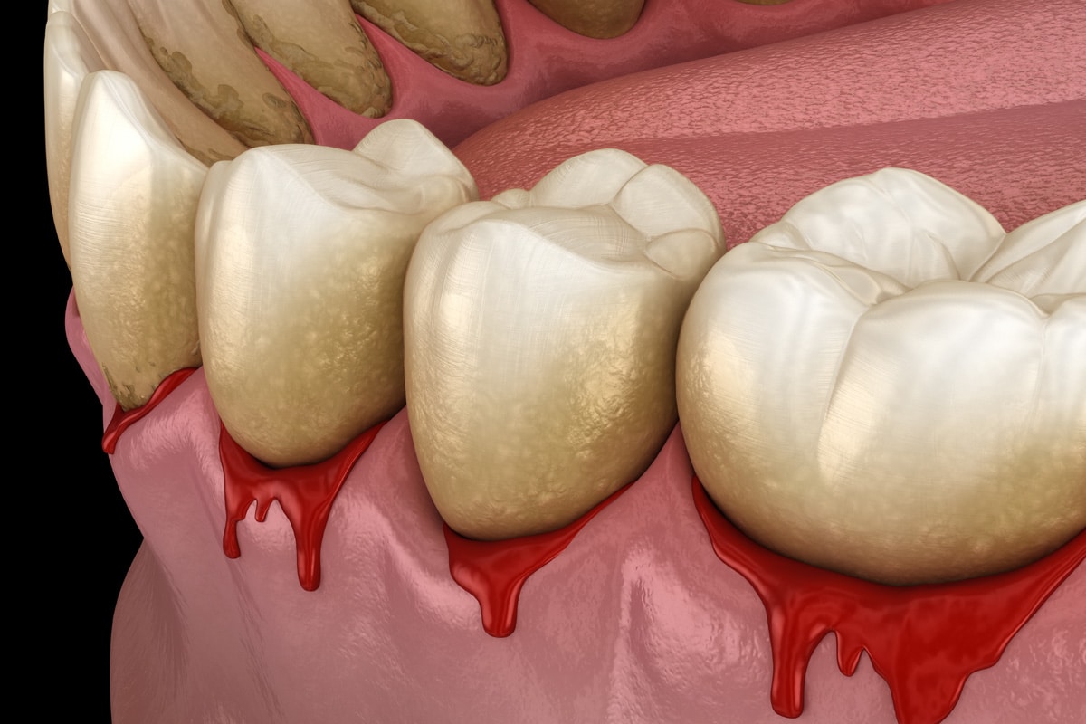 It’s National Gum Care Month! | American Dental Center