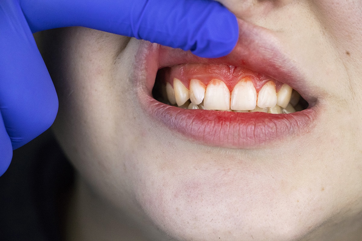 What Causes Bruised Gums and How to Treat Them