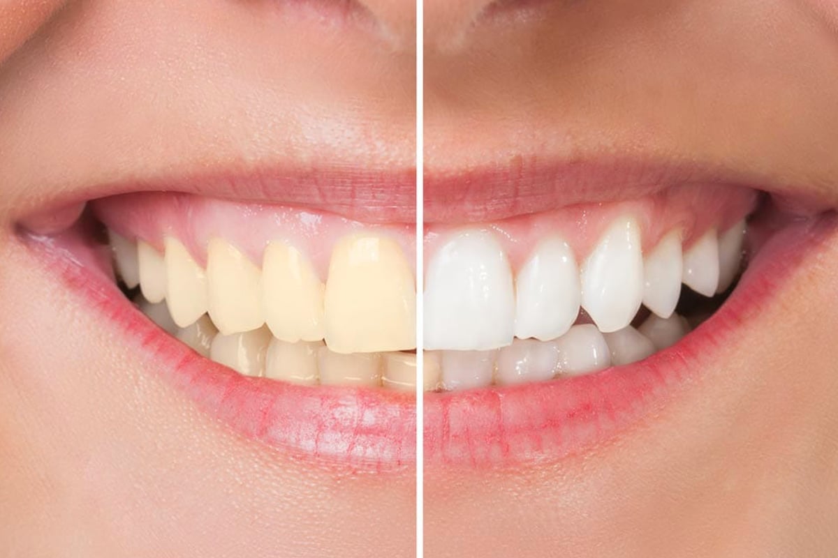 June 17th Is National Teeth Whitening Day, and We Are Here for It ...