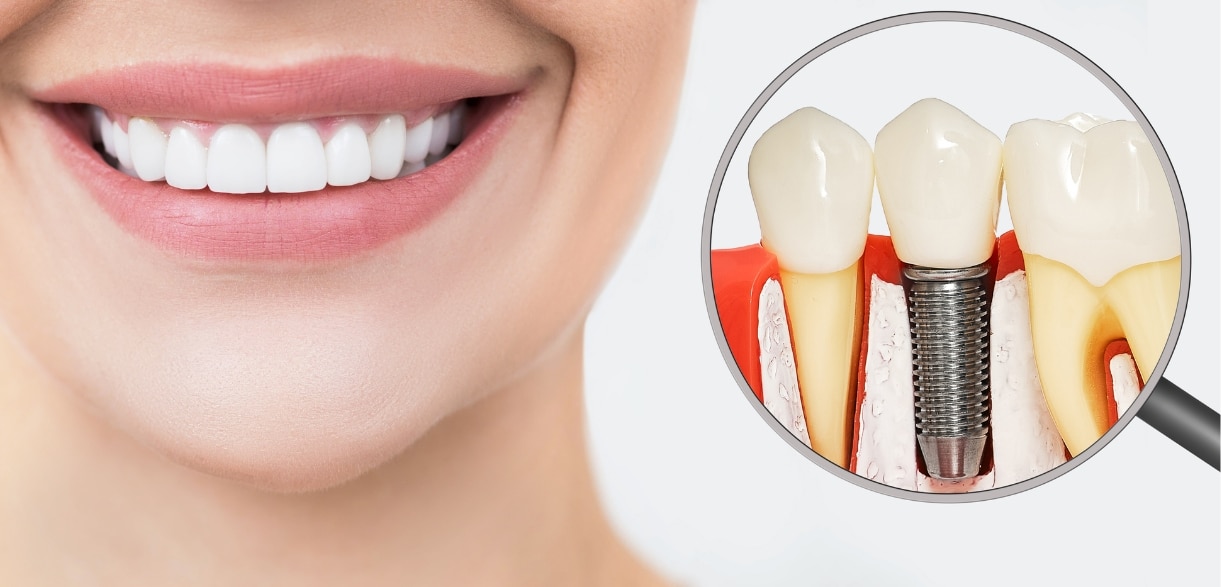 Dental Implants in Miami Gardens: 7 Key Considerations