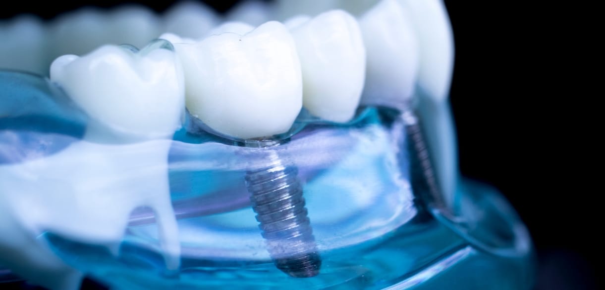 7 Stages of Dental Implant Placement
