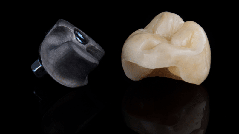 Dental Crown Calamity: Lifespan & Breakage